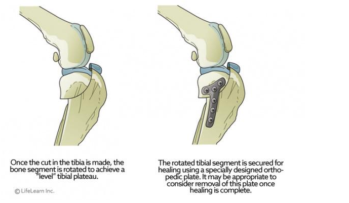 Cranial Cruciate Ligament Repair: Tibial Plateau Leveling Osteotomy ...